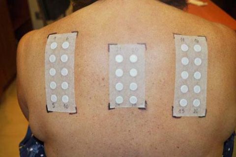 Prueba de parche, alergias, alergenos – Dermamedica